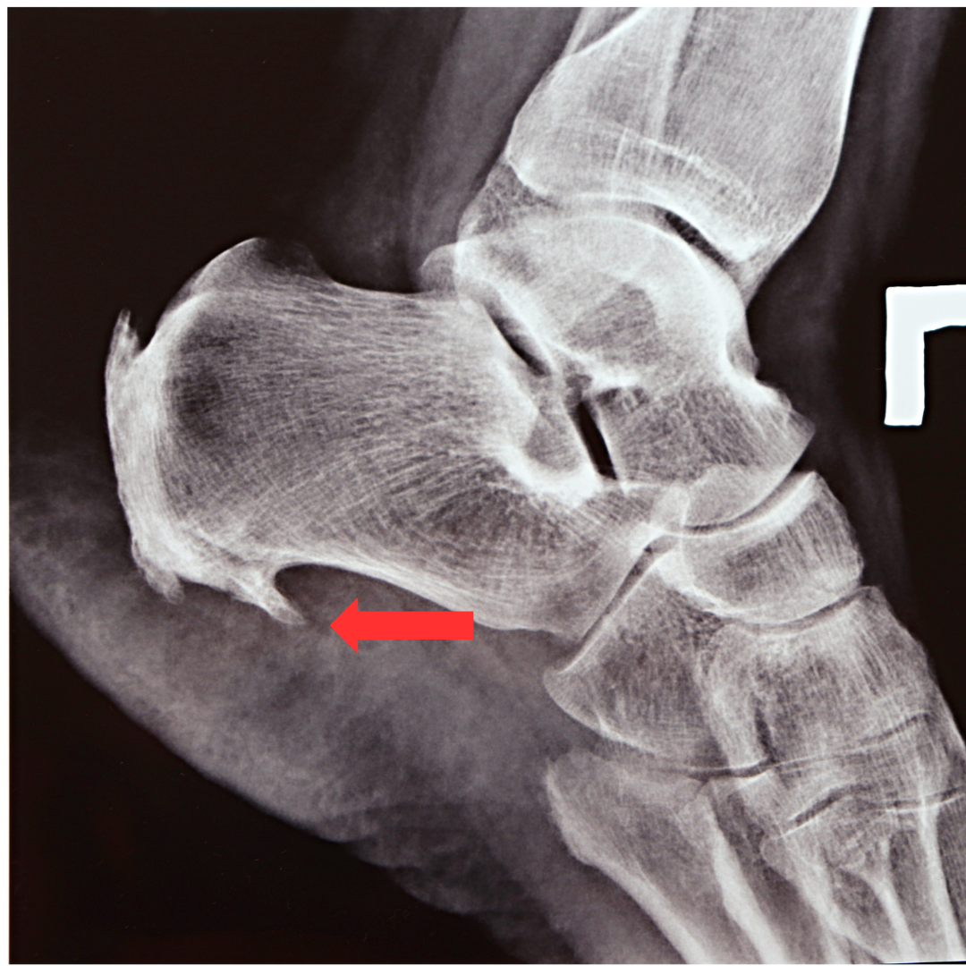 Walking on Thin Ice: How to Tell If It’s a Bone Spur or Plantar ...